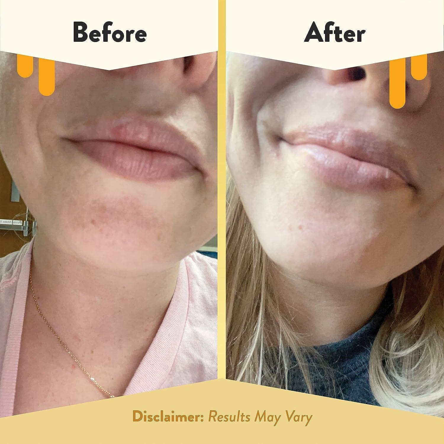 ECZEMA HONEY Nourishing Lip Balm - Repair Dry Cracked Lips ...