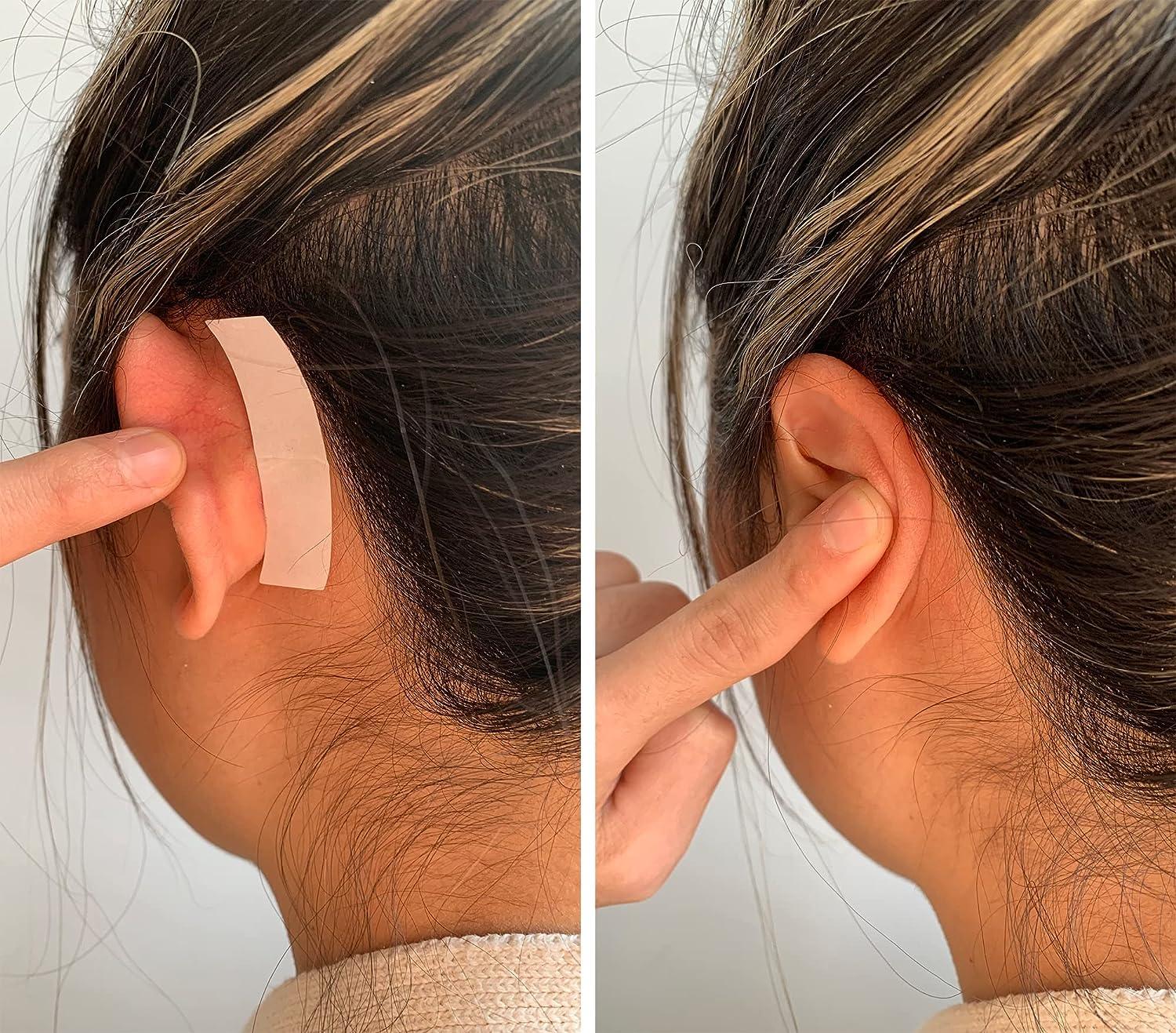 Earo Cosmetic Ear Corrector | Protruding Ear Solution | 20 Patches ...
