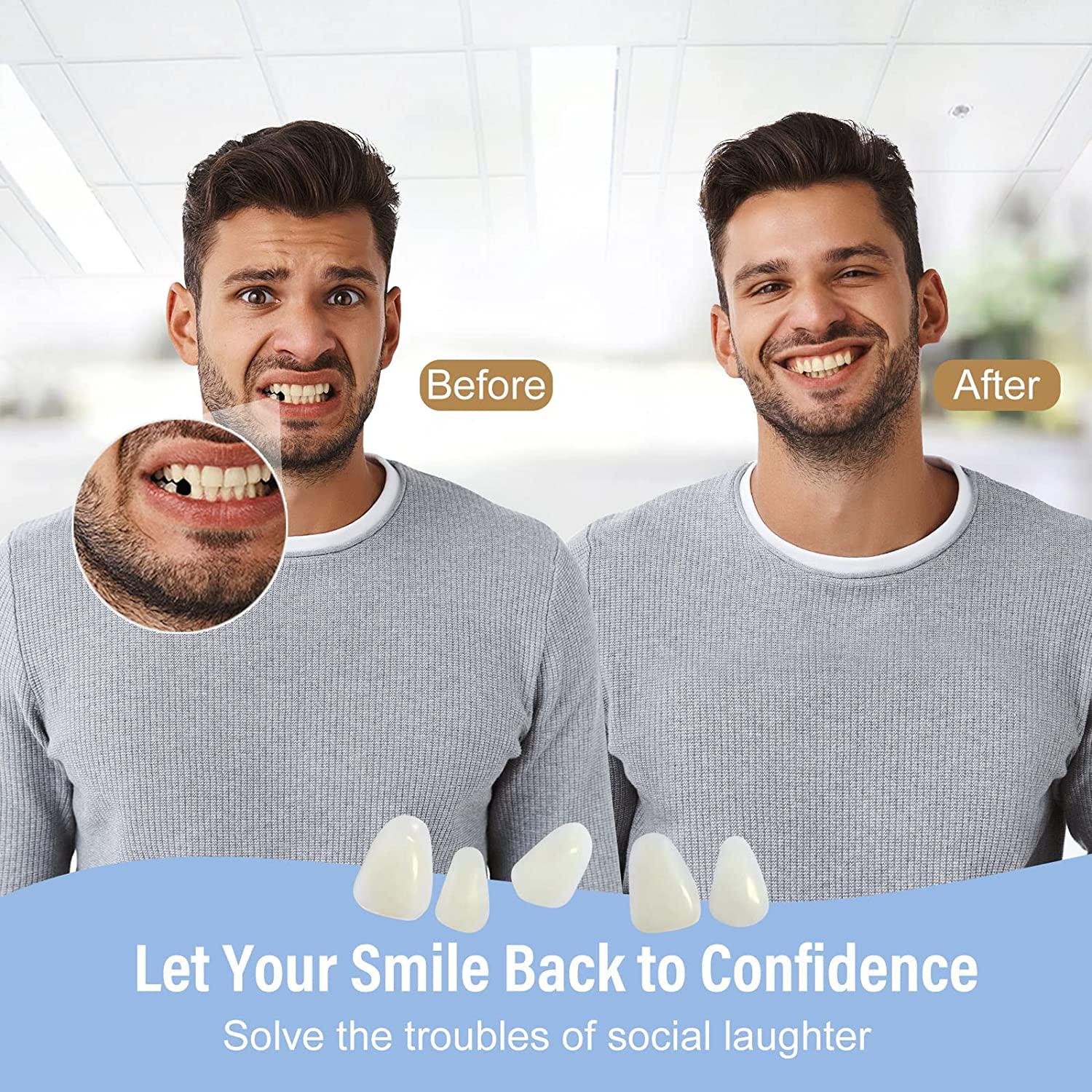 Fake Teeth Tooth Repair Kit, Natural Shade Fake Teeth Filling The Gap ...