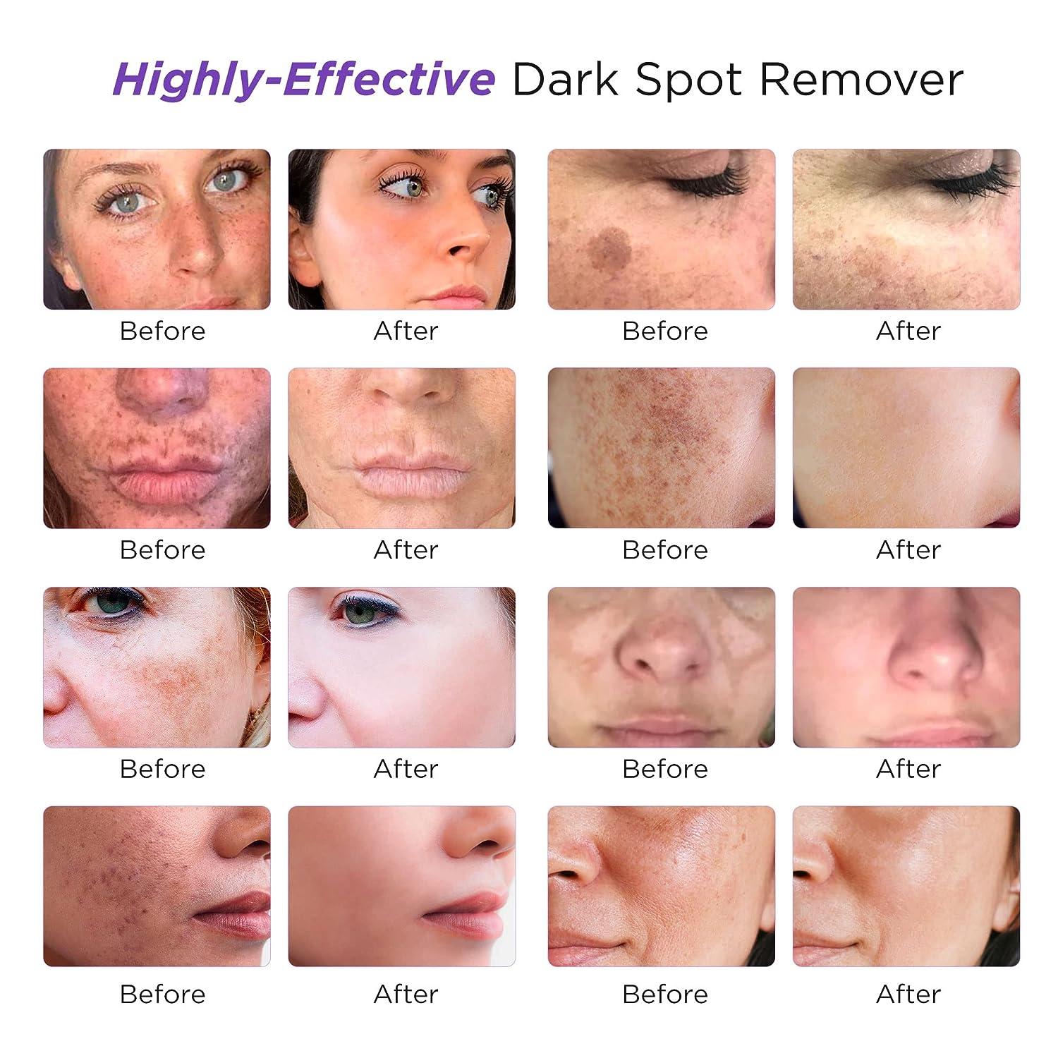 Dark Spot Remover for Face and Body - Melasma & Freckle Corrector - Hyperpigmentation Treatment ...