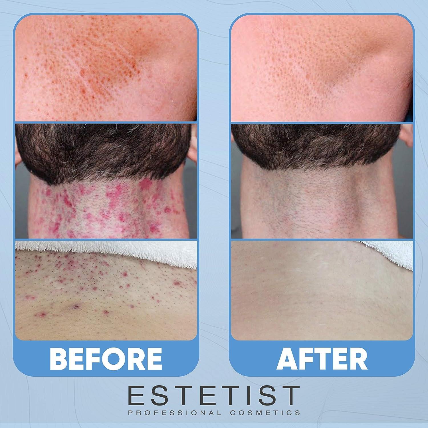 ESTETIST Razor Bump Stopper Solution with Salicylic Acid & Glycolic ...