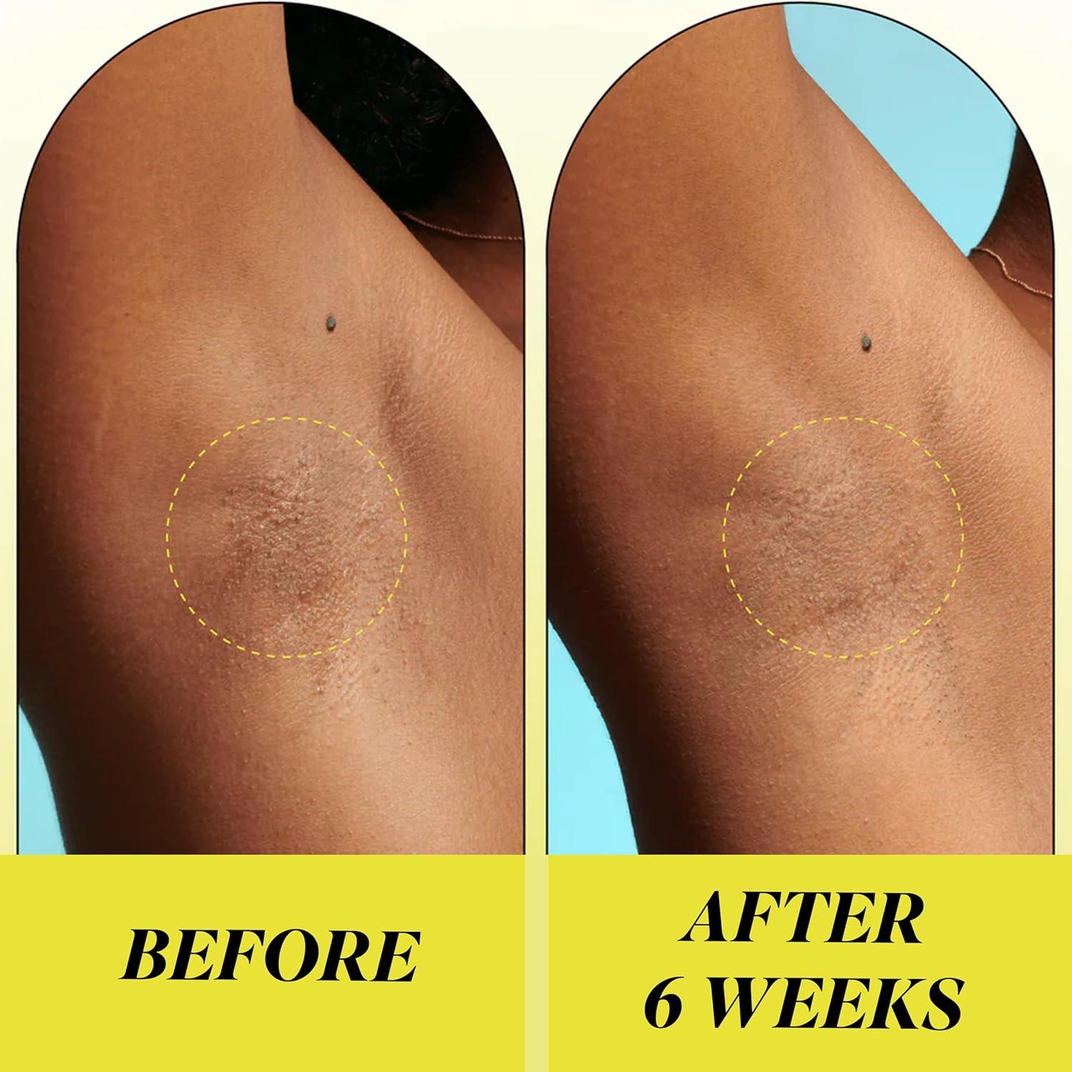 Fur Ingrown Deodorant | Water-Based Formula for Ingrown Hairs & Body ...