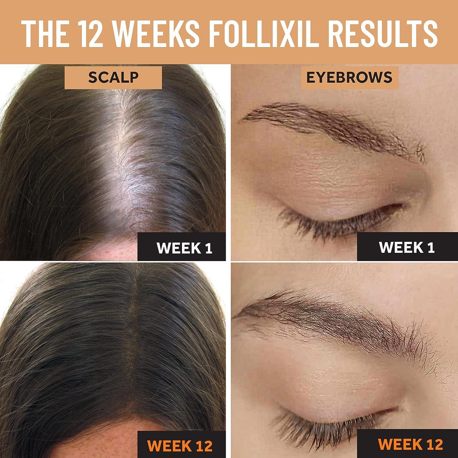 Minoxidil Before And After Eyebrows