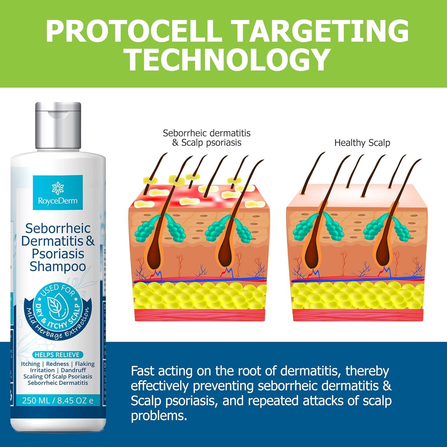 Roycederm Seborrheic Dermatitis Shampoo: Psoriasis, Dandruff ...