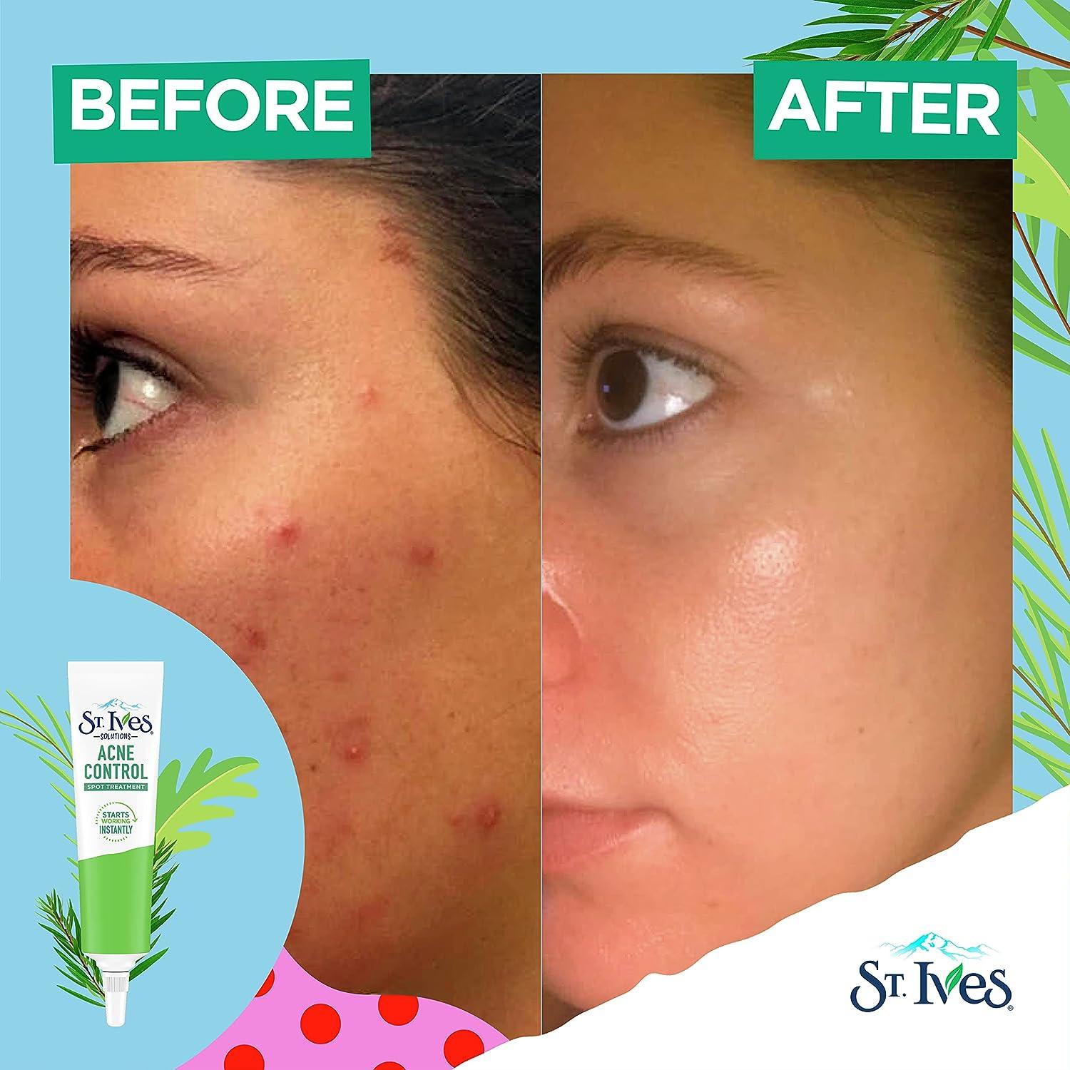 St. Ives Spot Treatment with 2% Salicylic Acid & Tea Tree Extract 0.75 ...