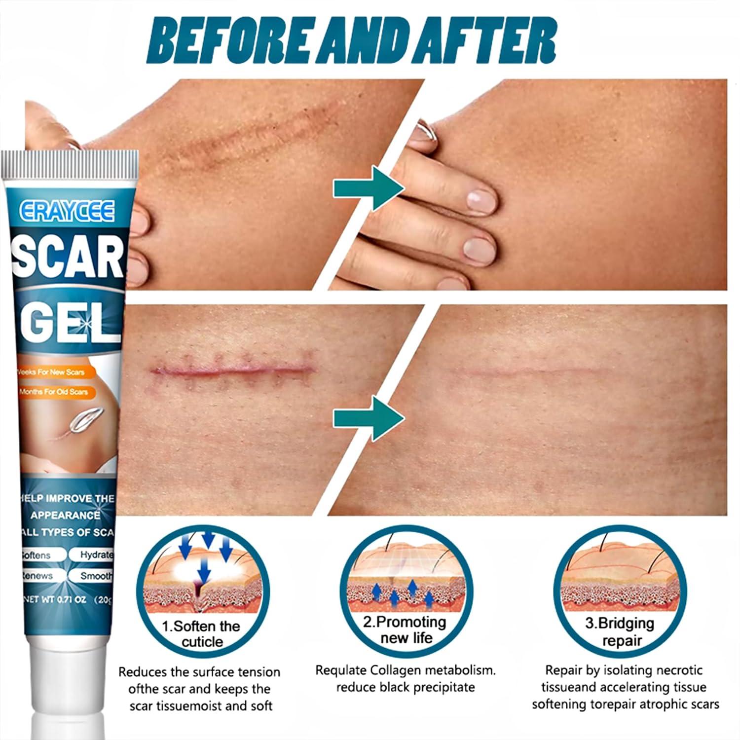 Scar Gel 20 G Effective in Treating Scars C-Section Scars Stretch Marks ...