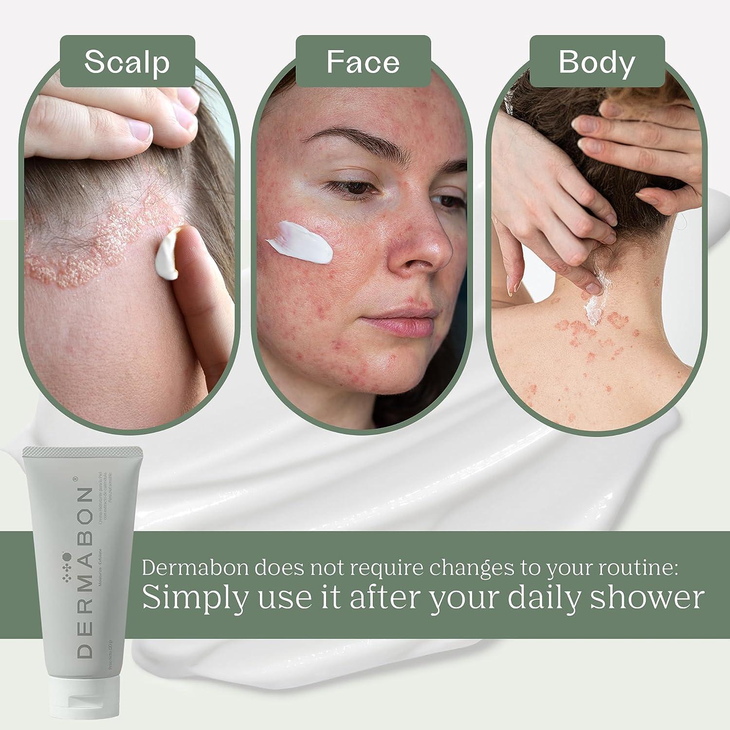 Dermabon Seborrheic Dermatitis Cream with Calendula Extract, Salicylic ...