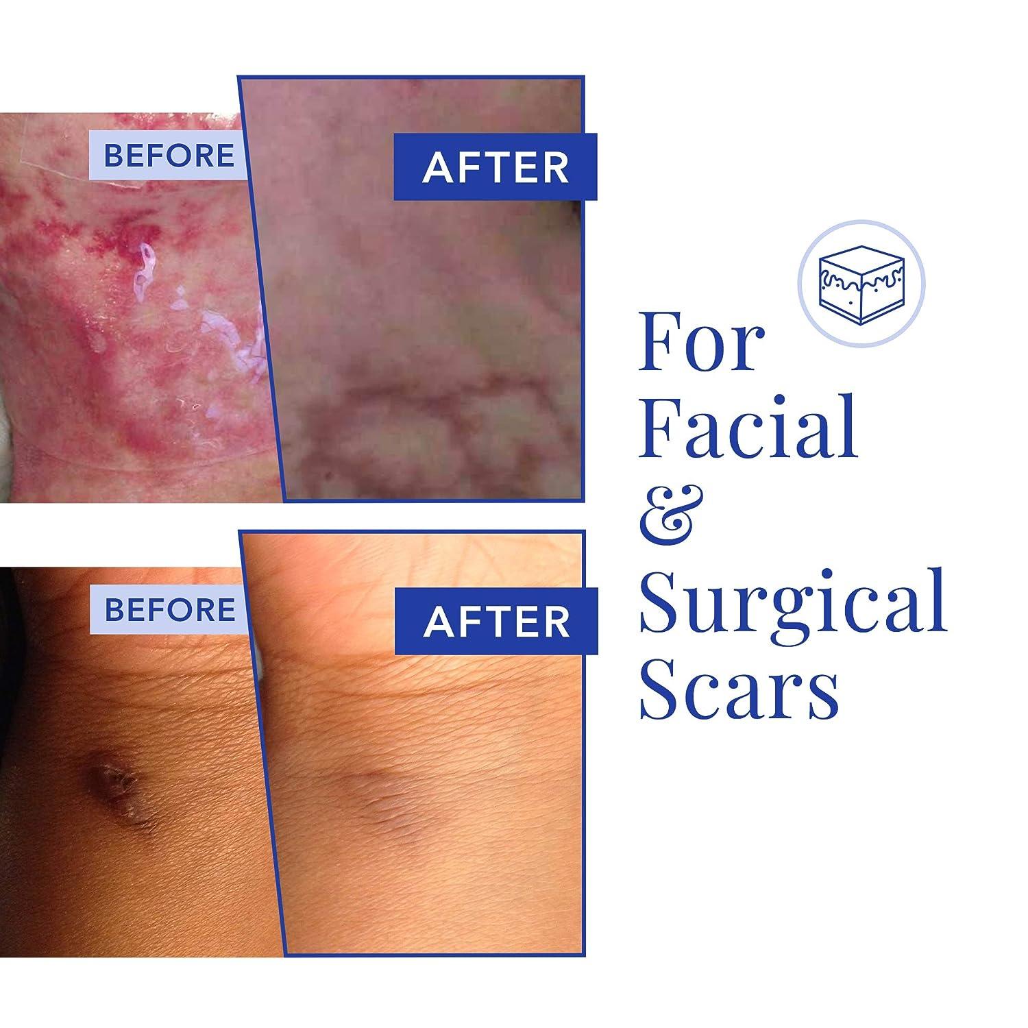 Rejuvaskin Scar Heal Kit - Medium Scar Treatment with Silicone Sheets ...