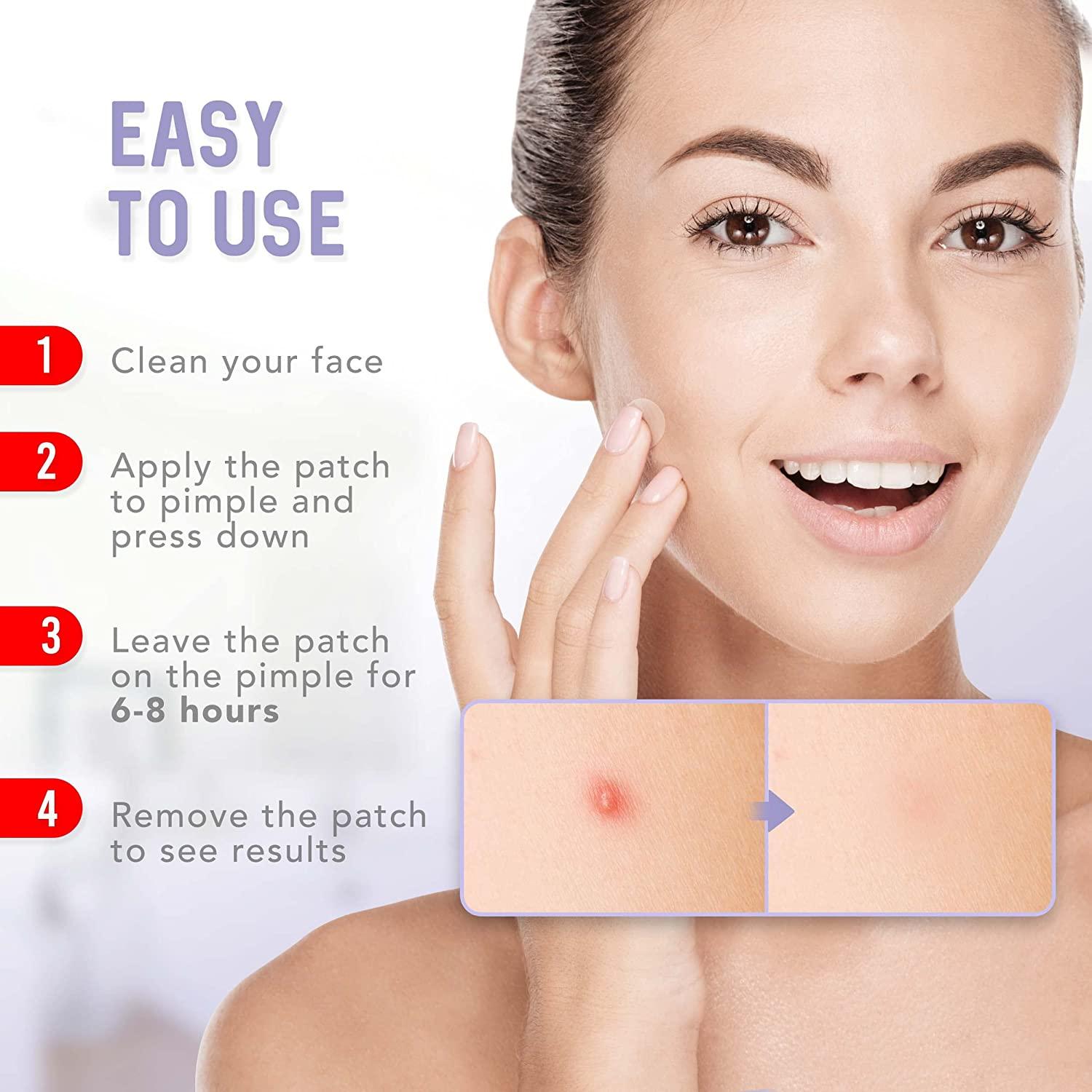 KEYCONCEPTS Pimple Patches (120 Pack) - Salicylic Acid and Tea Tree Oil ...