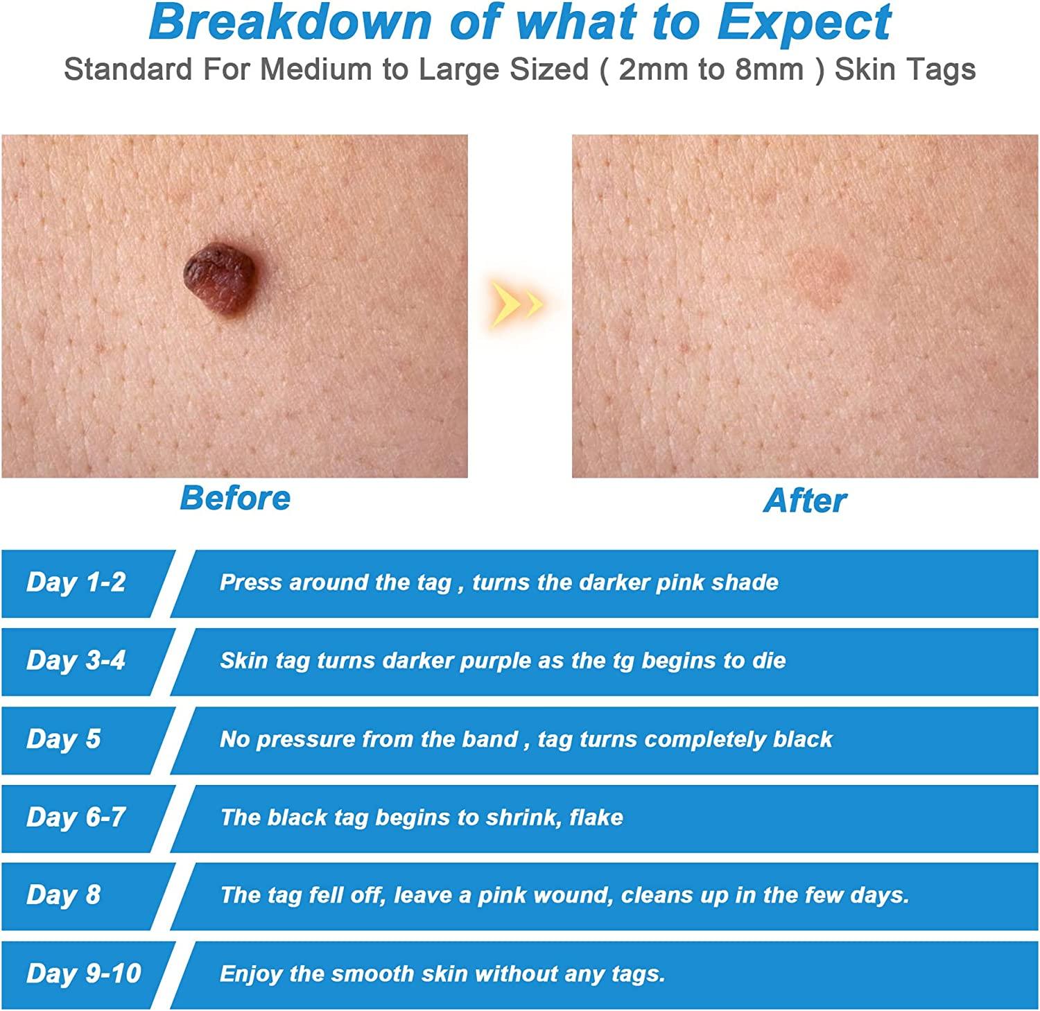 Painless Skin Tag Remover Pen Kit with 40 Bands - Easy Device for 2mm ...