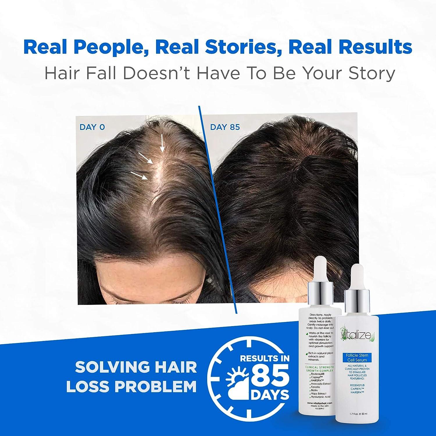 Follicle Stem Cell Serum with Redensyl, Capixyl, HairSpa - 1.7 fl oz ...