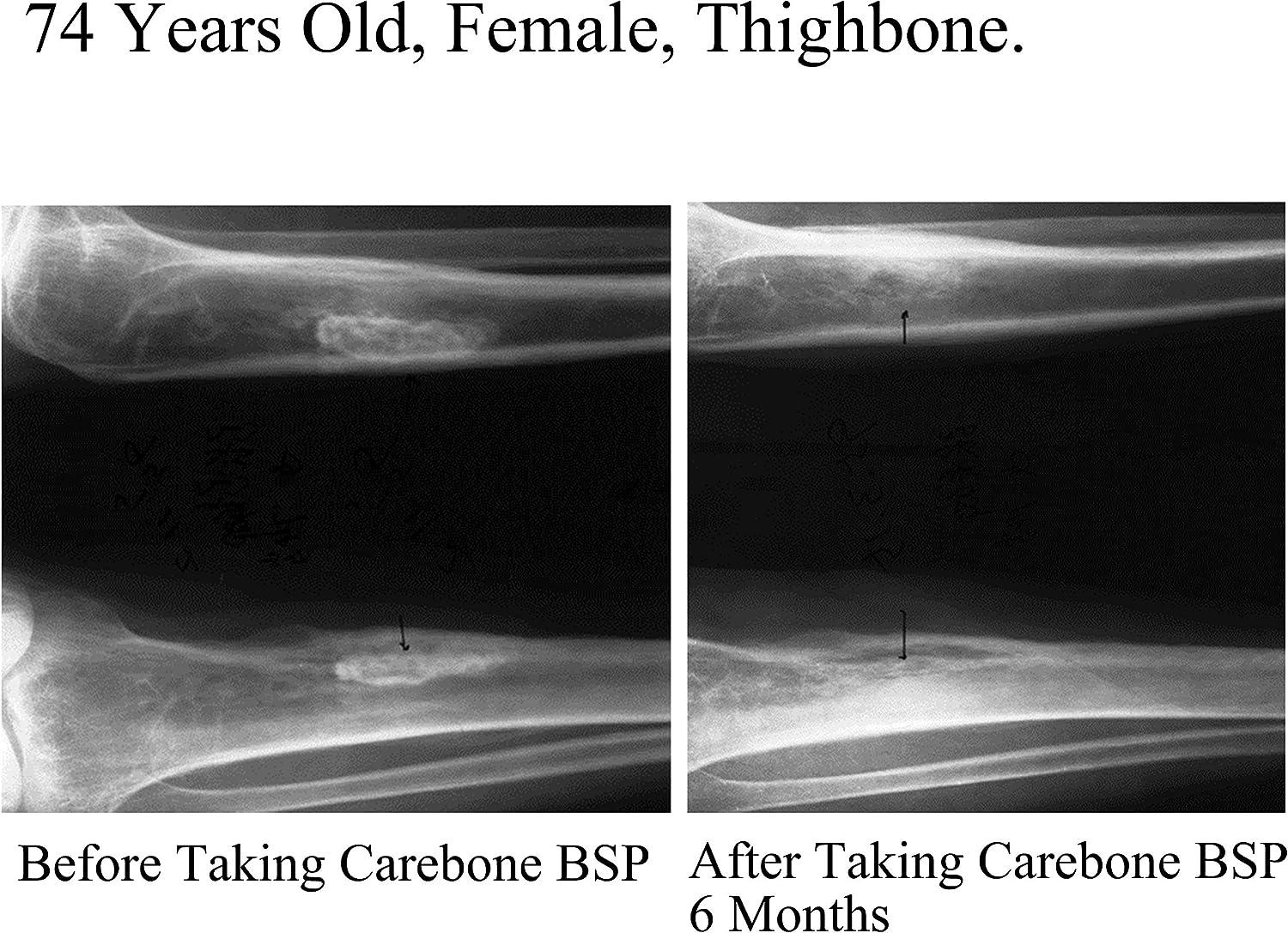 Carebone Bone-Strengthening Supplement BSP - 30 Tablets for Bone, Joint ...