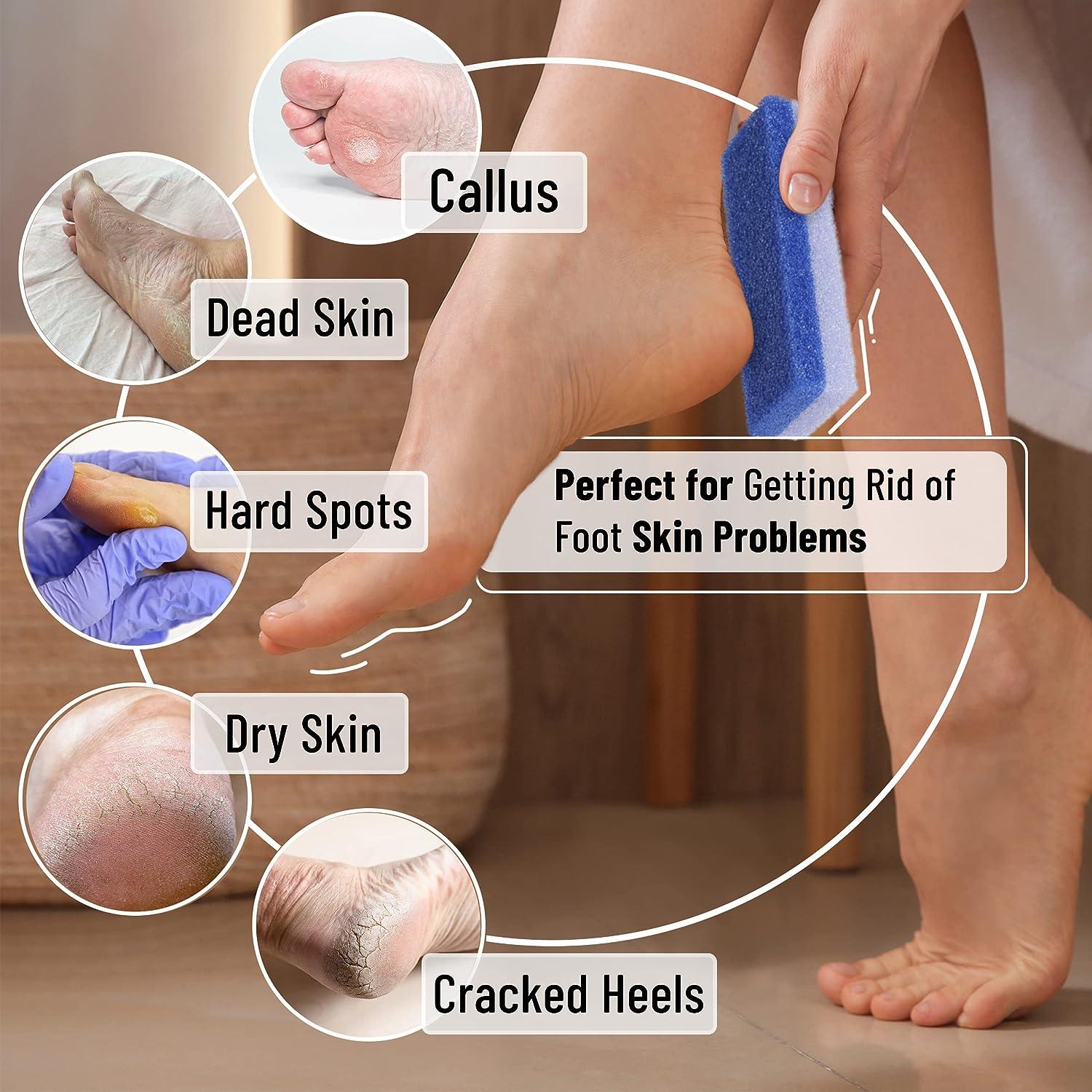 Slick Pumice Stone for Feet Callus Remover - 4 Pack, 2 Colors | Foot ...