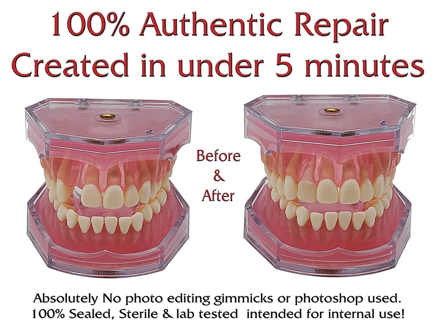 SmileFix Basic Dental Repair Kit - Quick & Safe Solution for Missing or ...