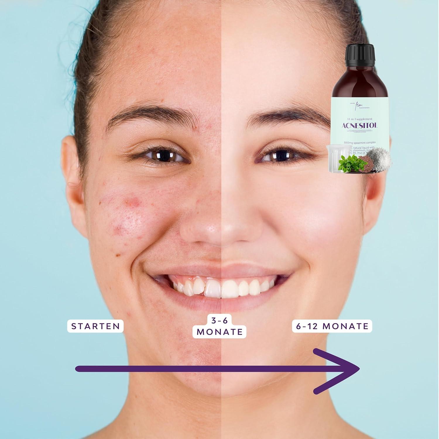 Inositol Fem Acnesitol 3000mg - Hormonal Acne Solution Female Balance ...