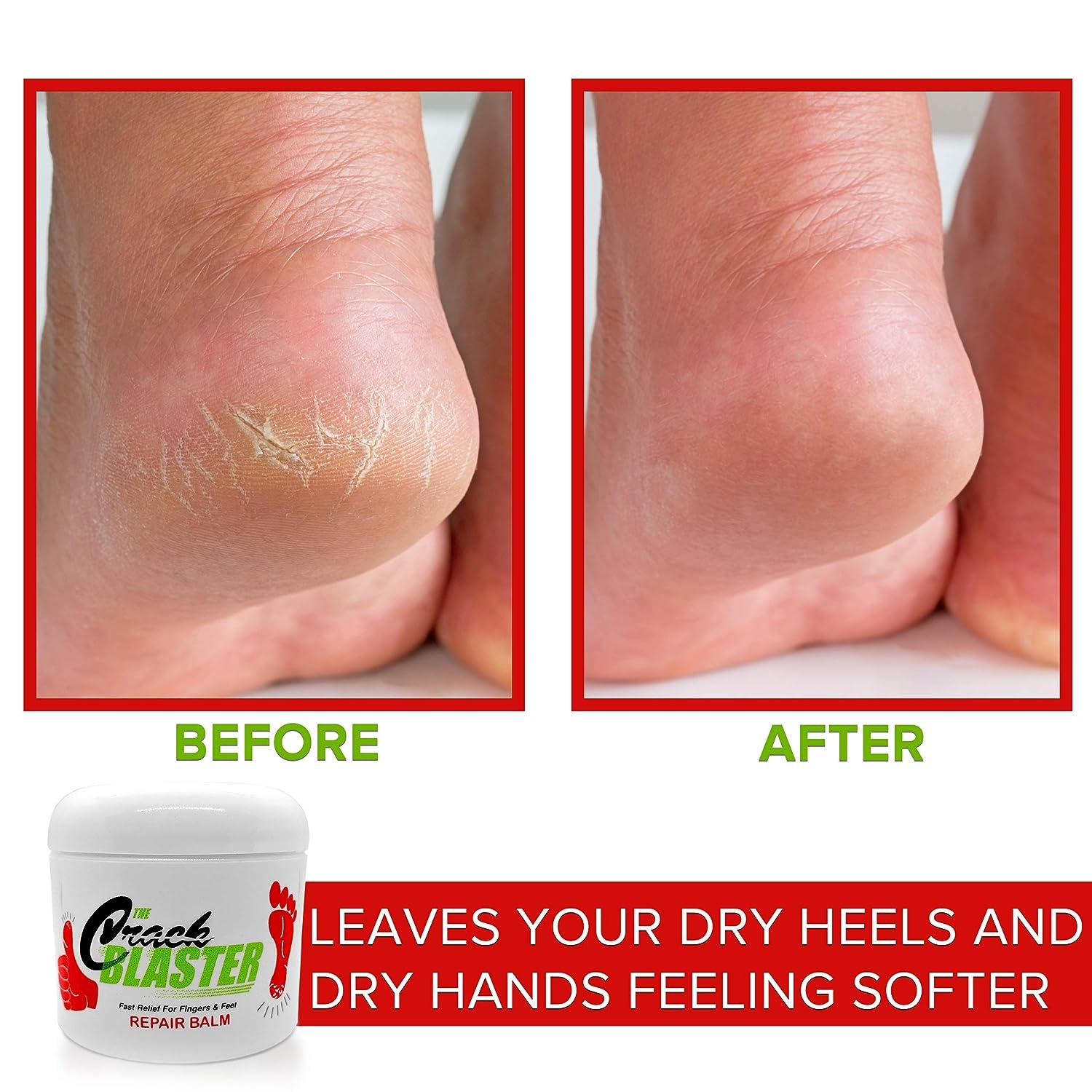 Crack Blaster Repair Balm - Intense Treatment for Dry Cracked Heels ...