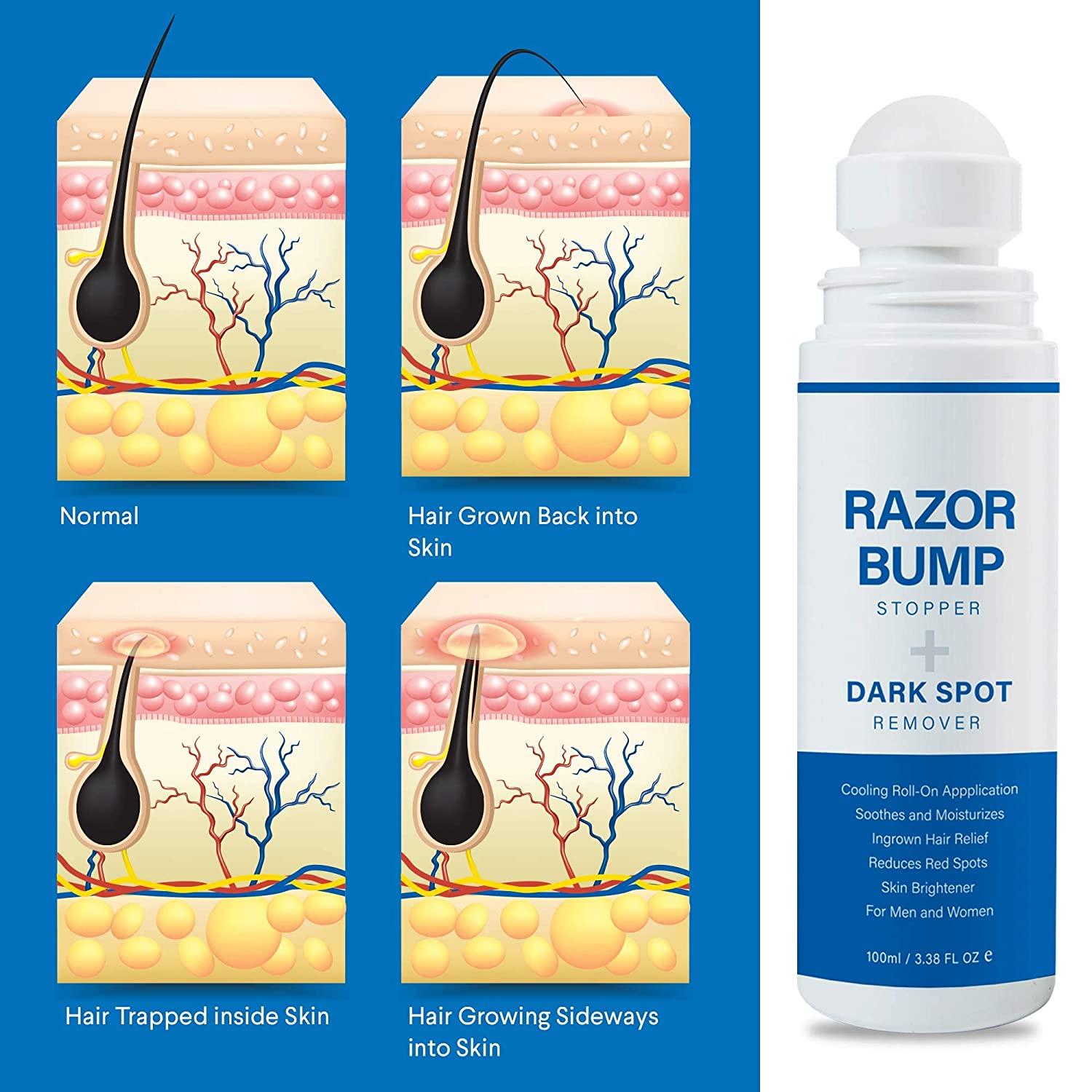 Razor Bump Stopper & Dark Spot Remover: Ingrown Hair Treatment for Men ...