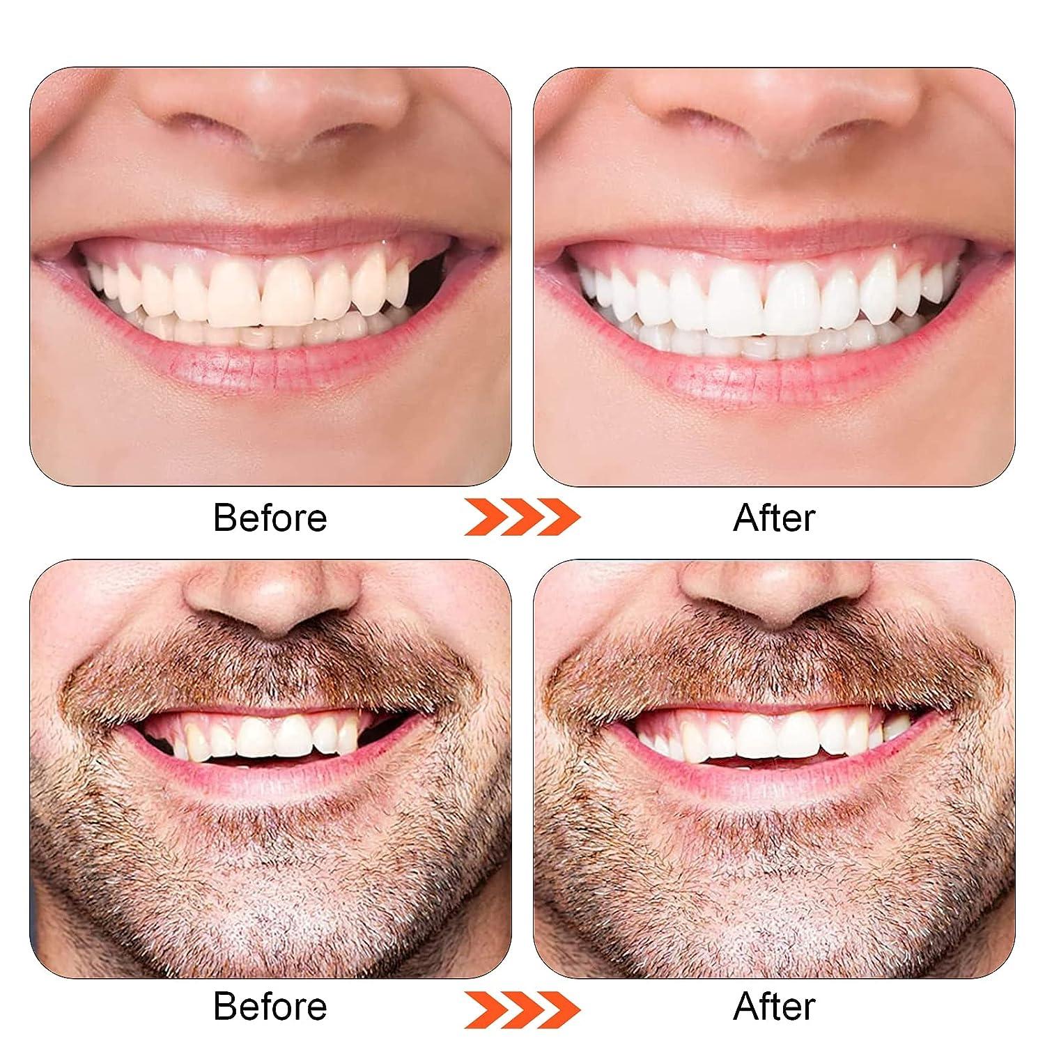 Tooth Repair Kit - Natural Shade Temporary Filling for Missing or ...