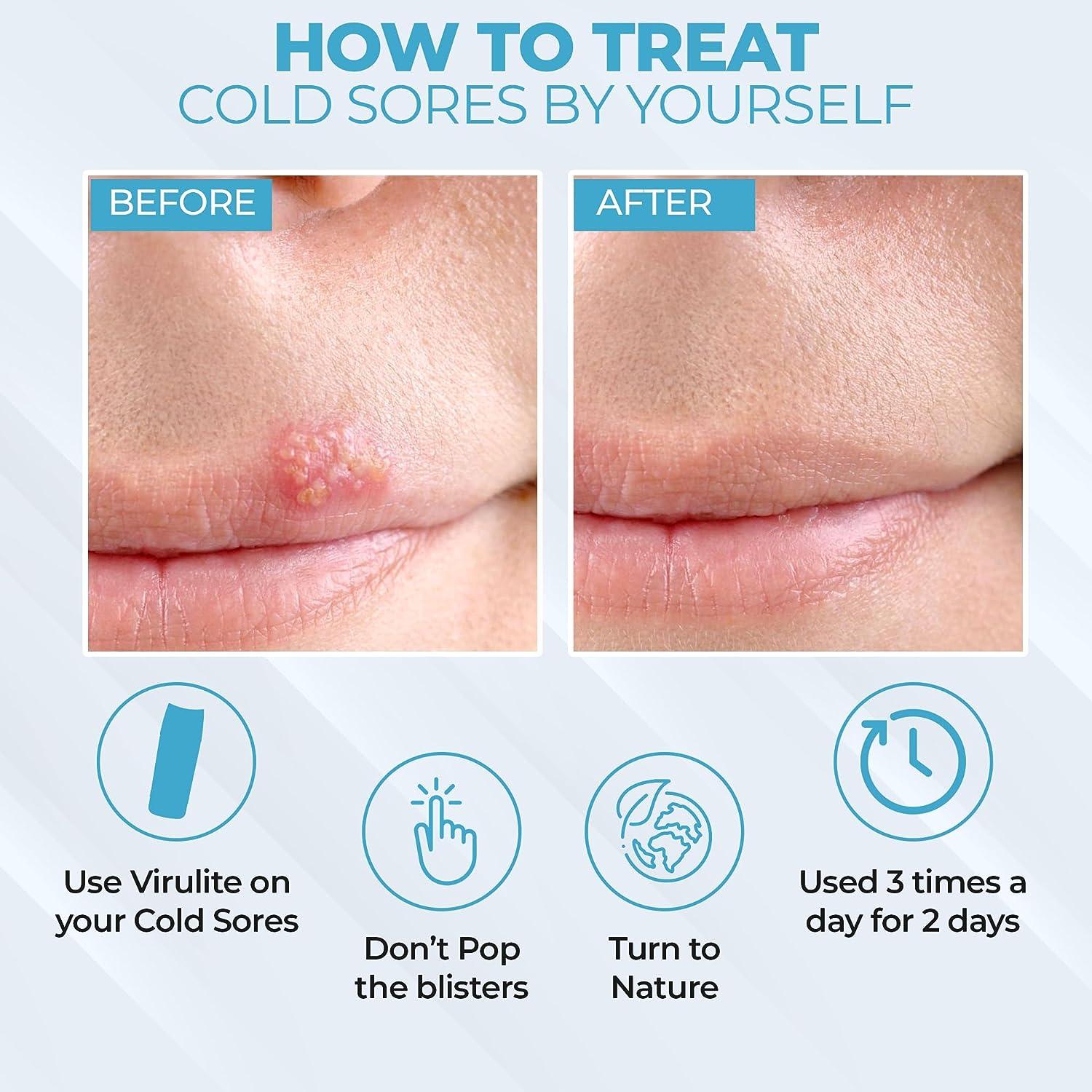 Virulite CS Original: FDA Cleared Cold Sore Treatment Device - 300 ...