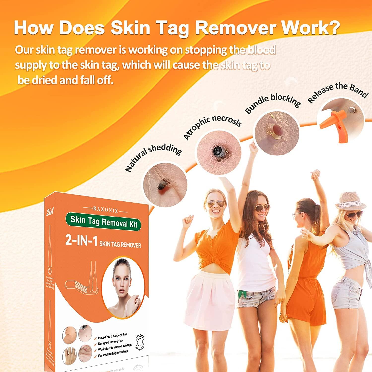 2-in-1 Skin Tag Remover Kit Safe & Painless Removal for Small to Large ...