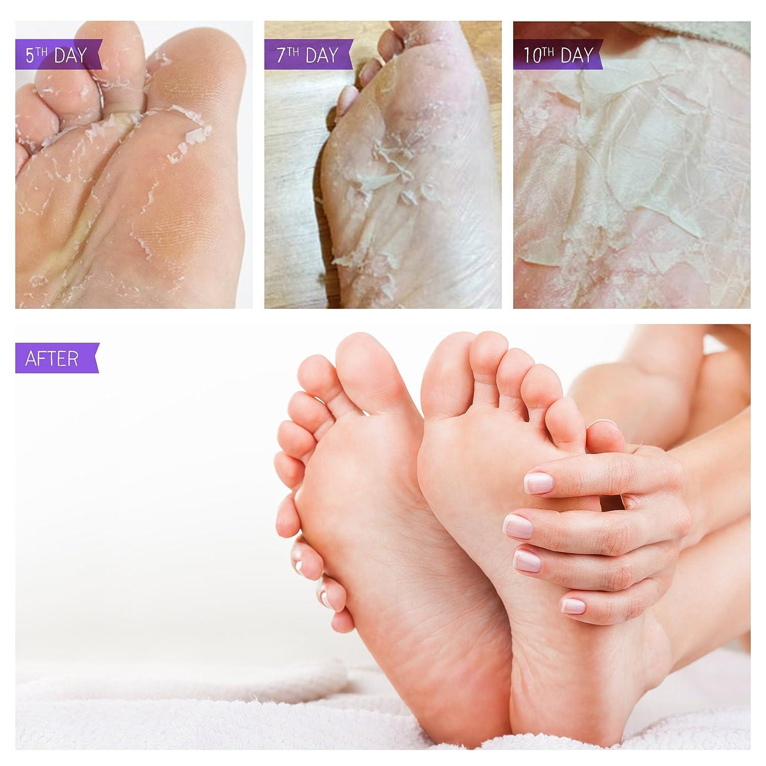 Foot Peel Mask for Exfoliating Calloused Heels - Deep Skin Treatment ...