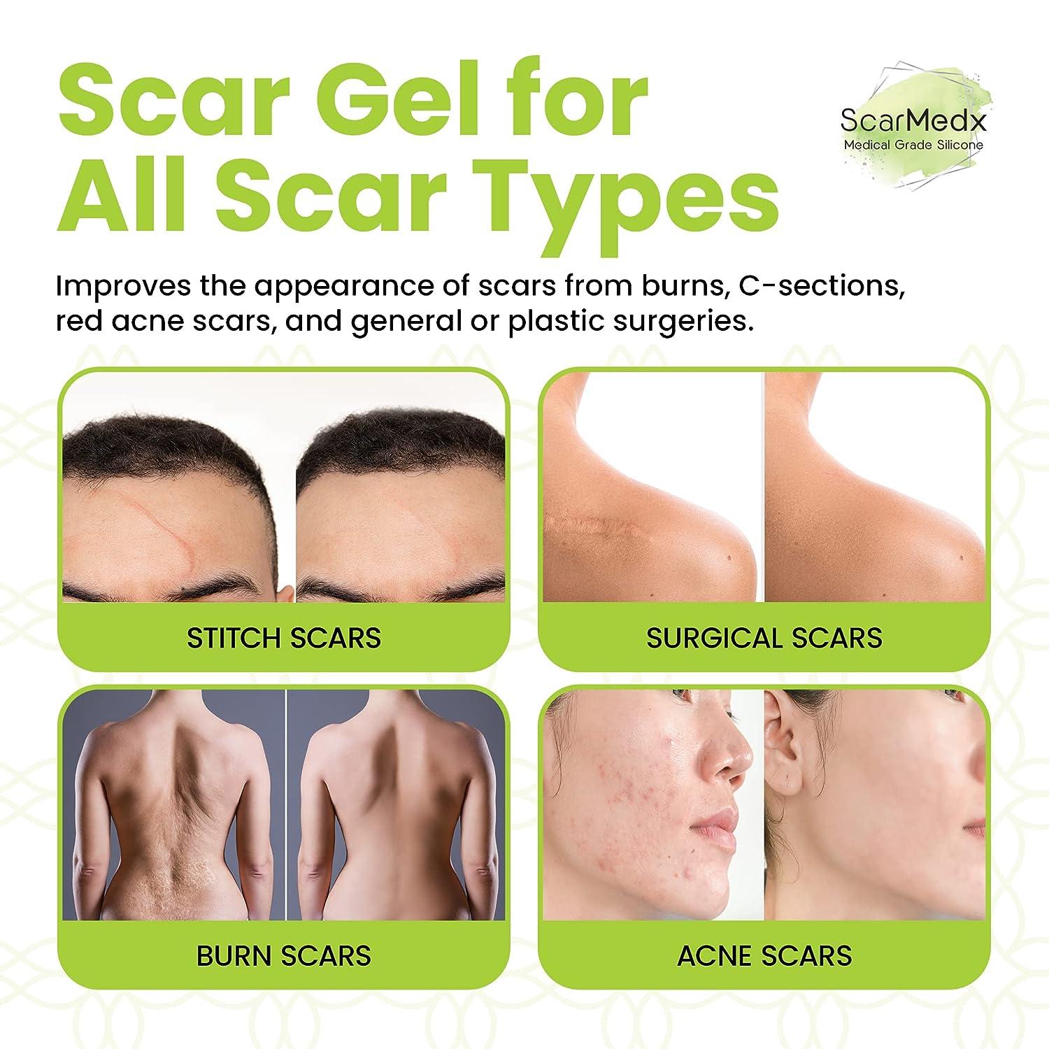 ScarMedx Advanced Scar Gel - Medical Grade Silicone Treatment for ...