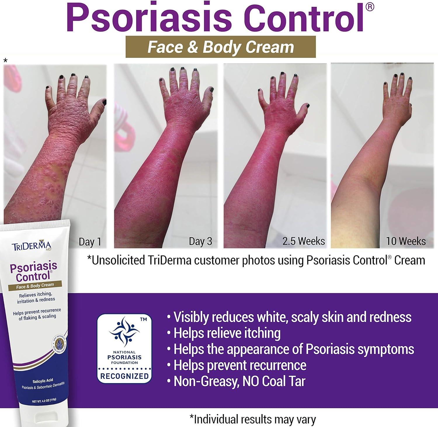 TriDerma Psoriasis Control Cream & Body Wash Bundle - 4.2oz & 16oz ...
