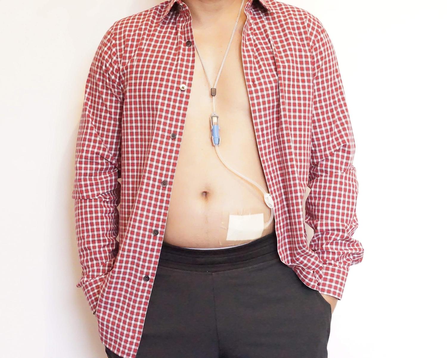 Peritoneal Dialysis Transfer Set Holder Customized for Smaller PD ...