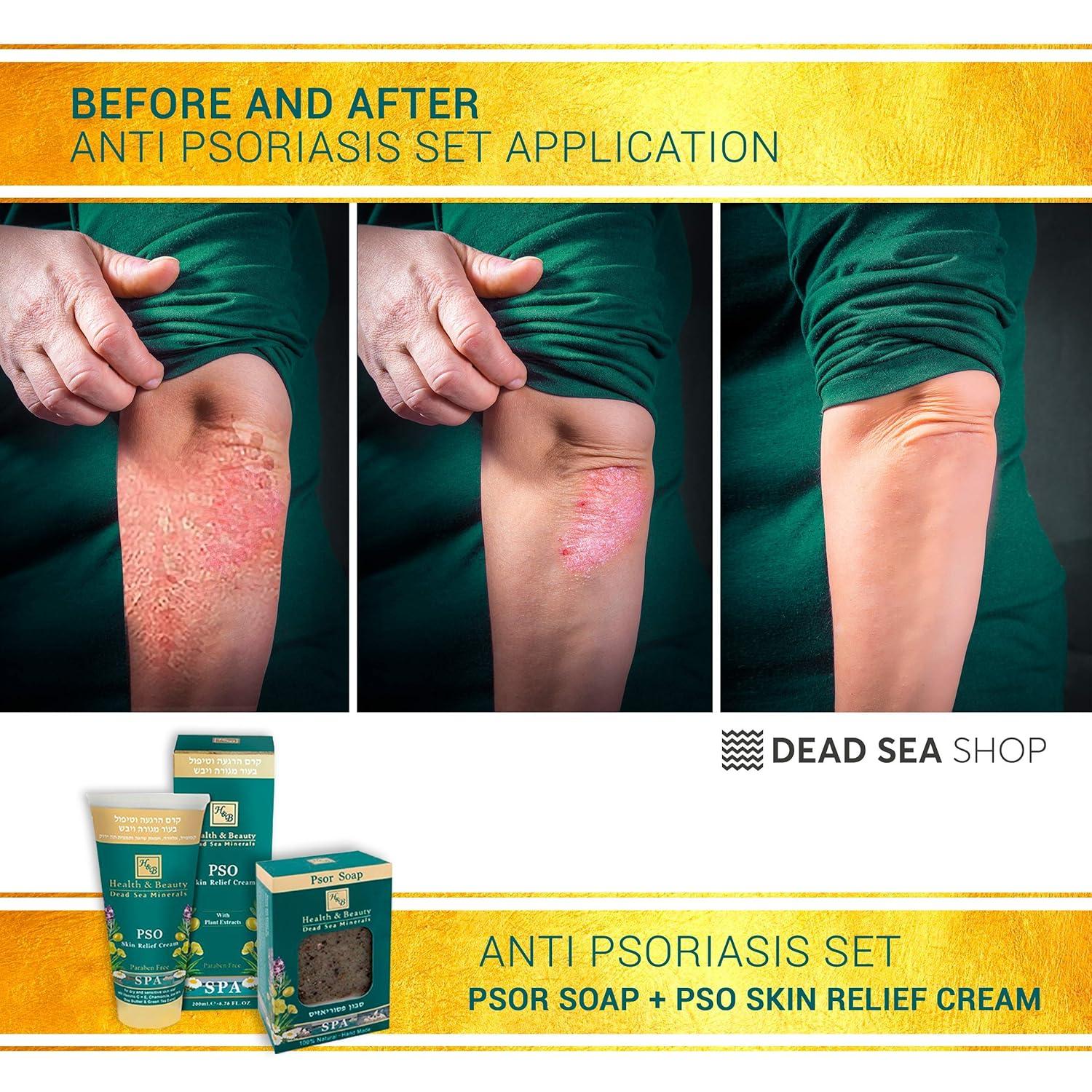 Dead Sea Minerals Anti Psoriasis Set: Psor Soap + Pso Skin Relief Cream ...