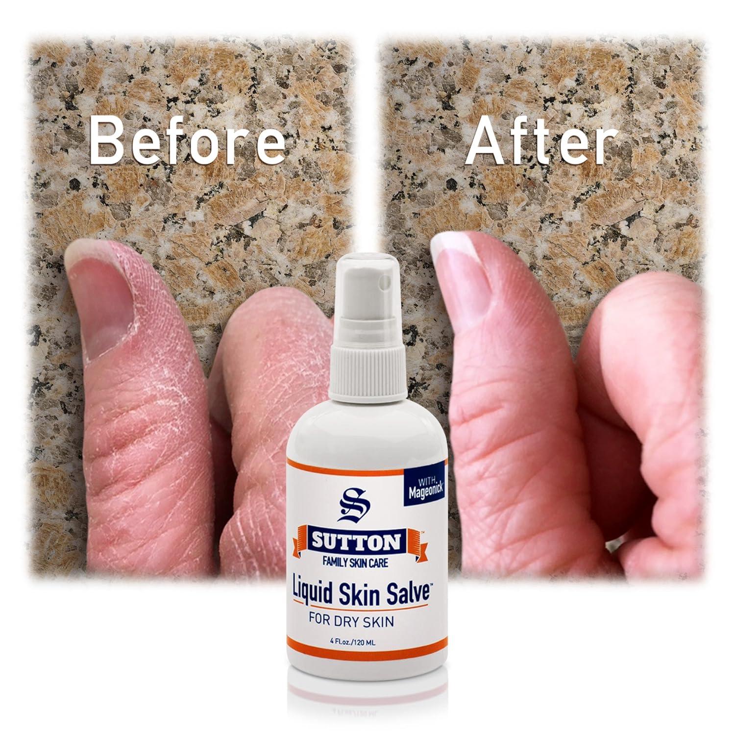 Premium Spray-On Liquid Skin Salve - Fast Absorbing Formula for Dry ...