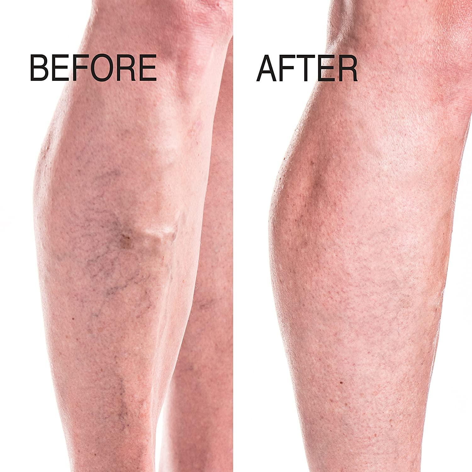 Varicose Veins Arms