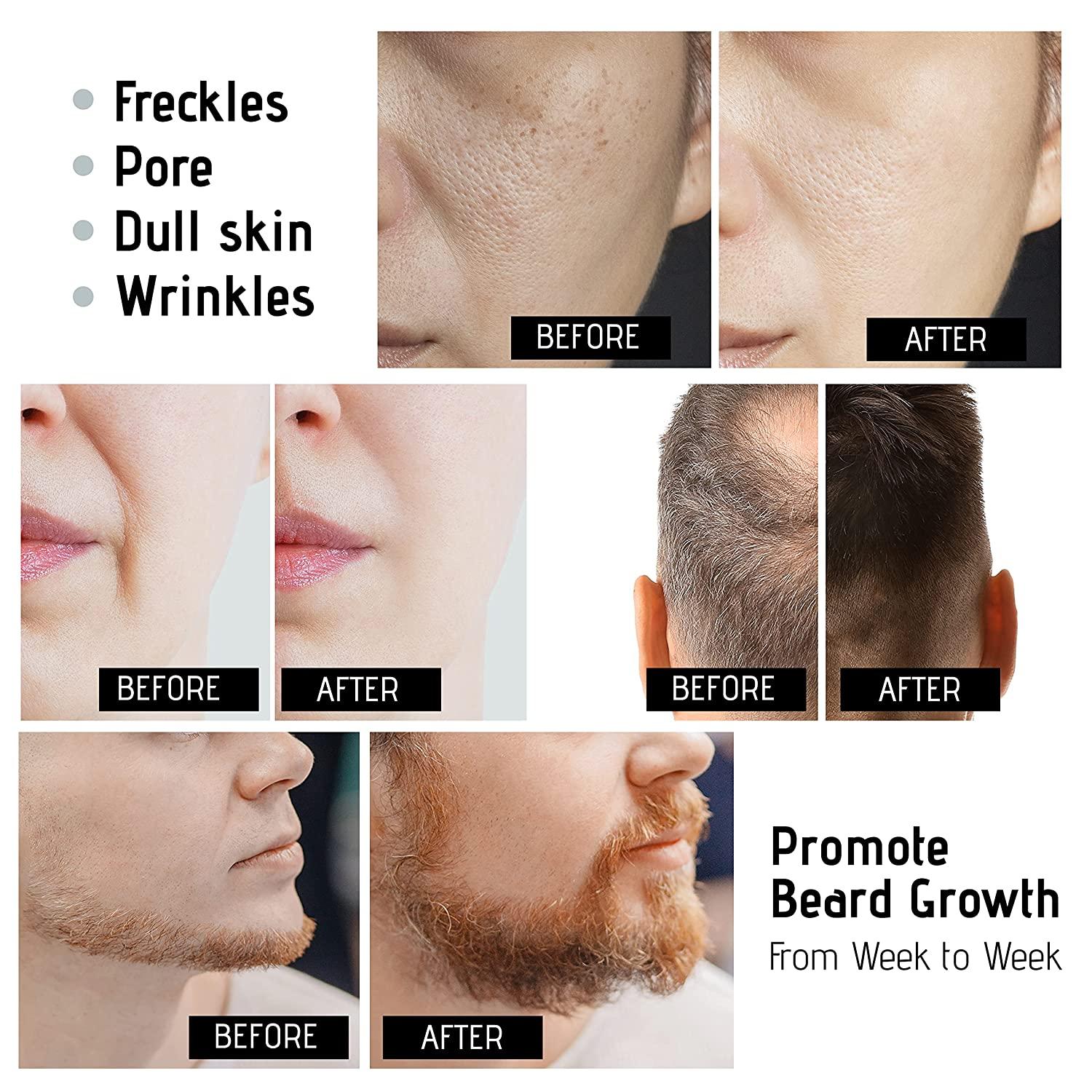 Derma Roller Microneedle Roller for Face & Beard Growth Kit - 0.25mm ...