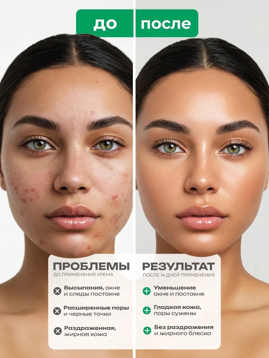 BIOAQUA Acne cream with salicylic acid | Buy Now with Express ...